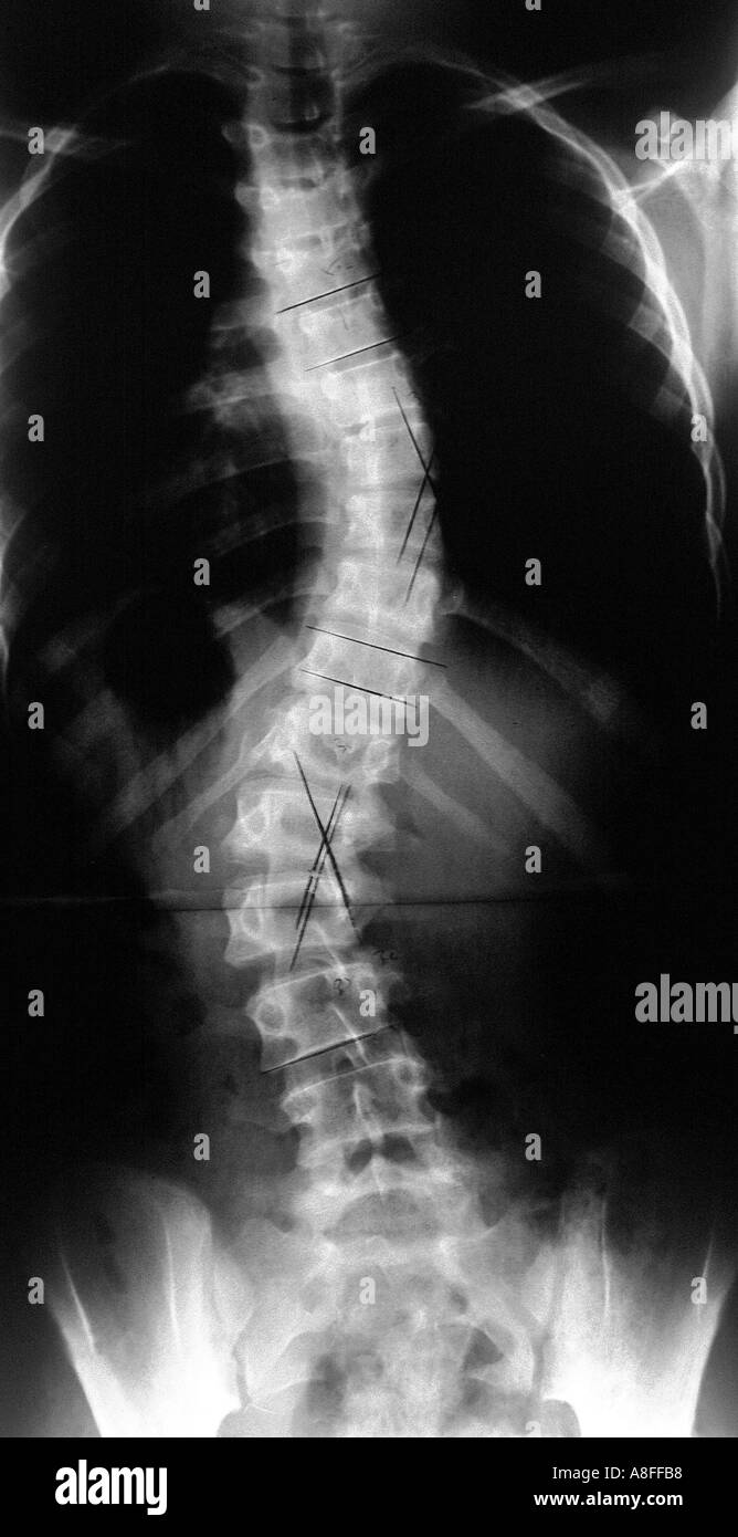 Radiographie de la scoliose Banque de photographies et d’images à haute ...