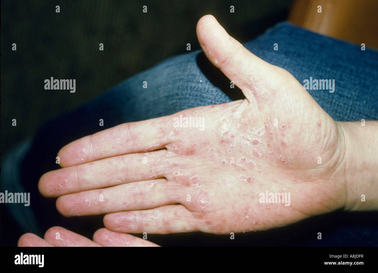 Peau de psoriasis genoux Banque de photographies et d’images à haute ...