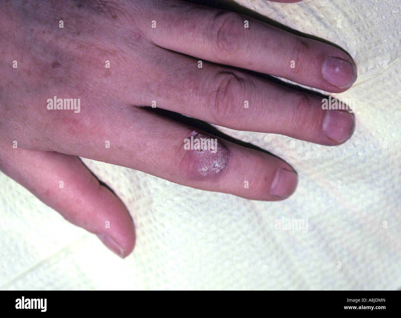 Verruca plana Banque de photographies et d’images à haute résolution ...