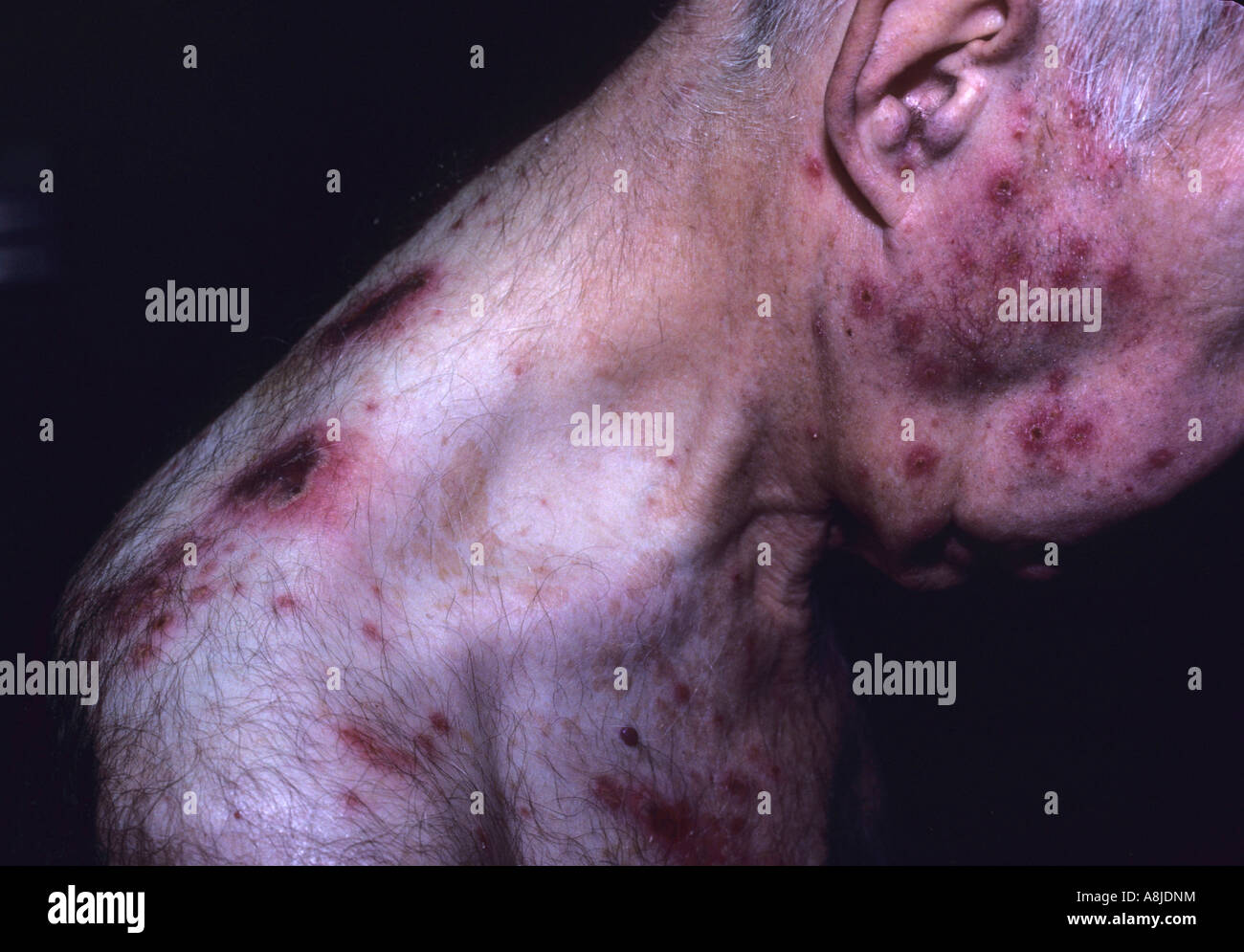 Zona éruption cutanée main Banque de photographies et d’images à haute ...