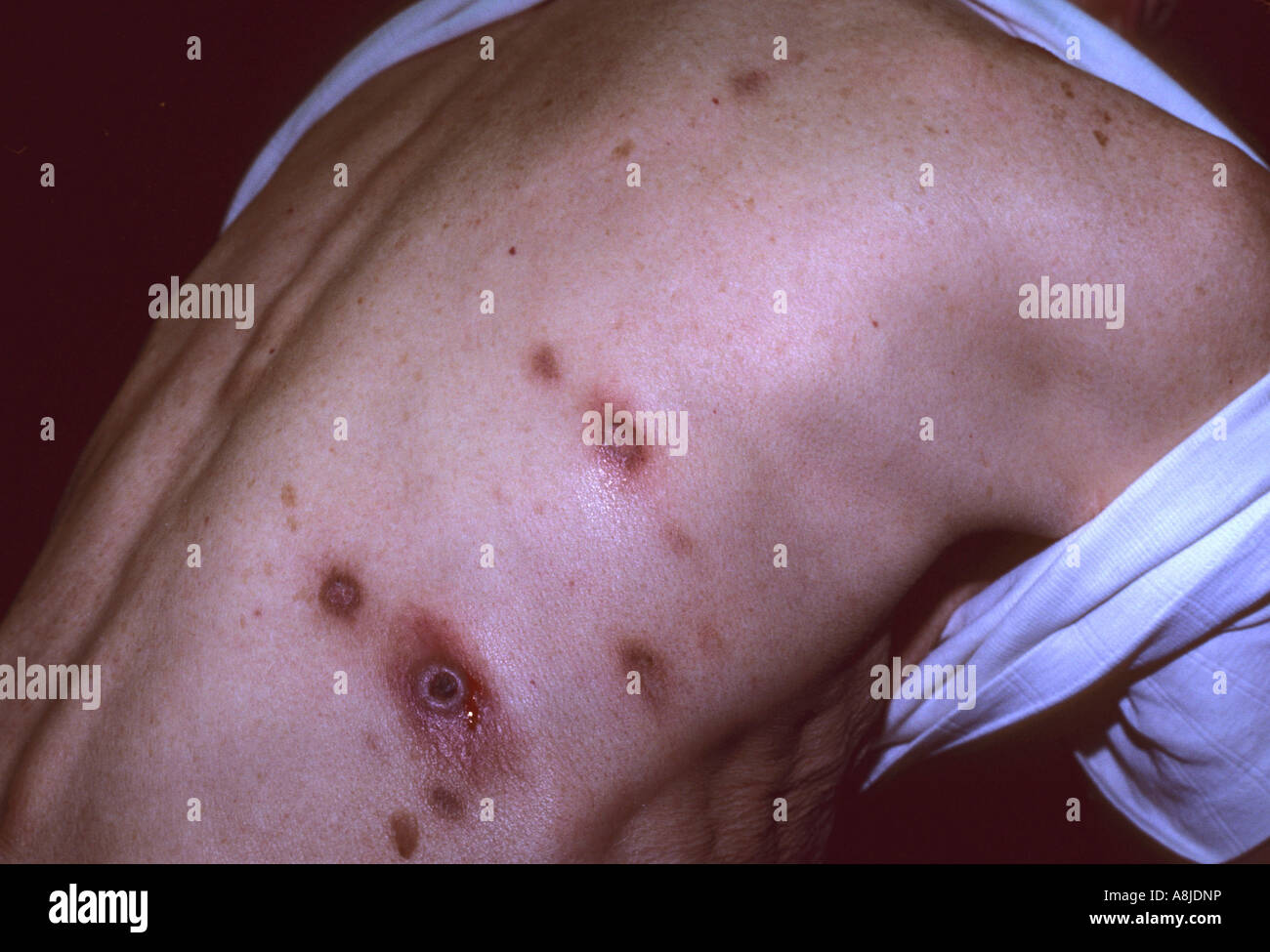 Zona éruption cutanée Banque de photographies et d’images à haute ...