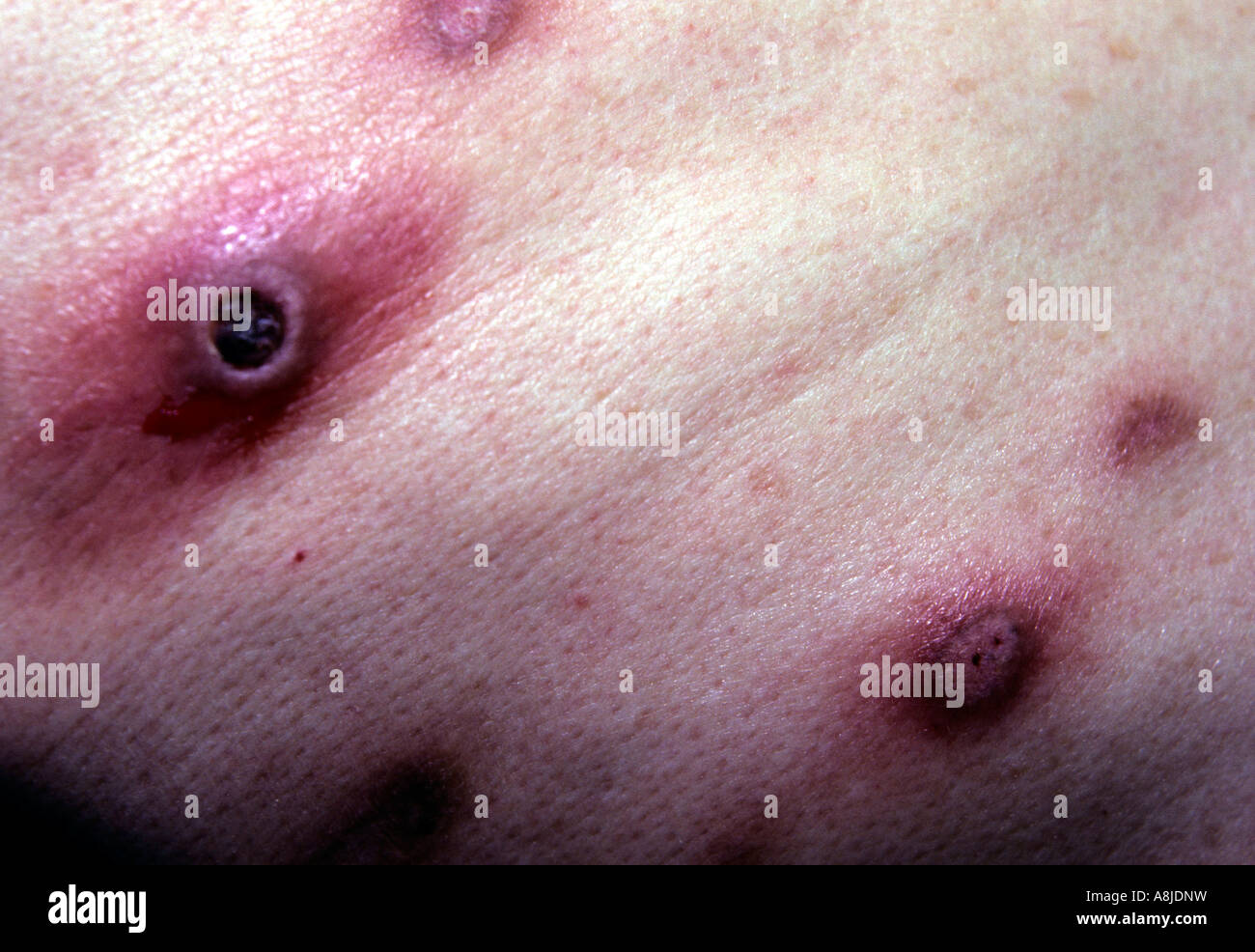 Zona éruption cutanée Banque de photographies et d’images à haute ...