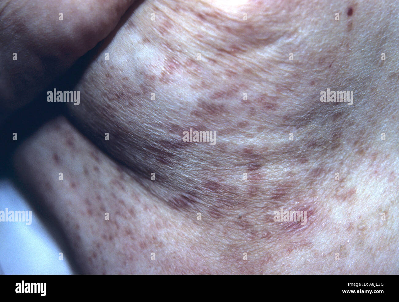 La maladie de Paget du sein est un eczéma-comme changement de la peau ...