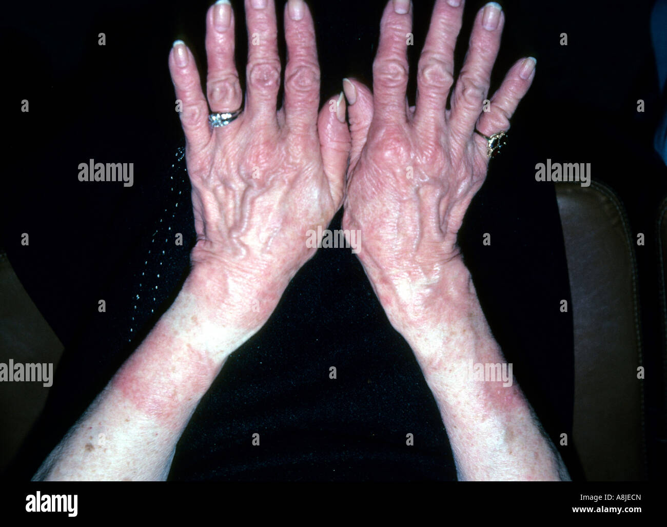 Skin rash eczema on hands Banque de photographies et d’images à haute ...