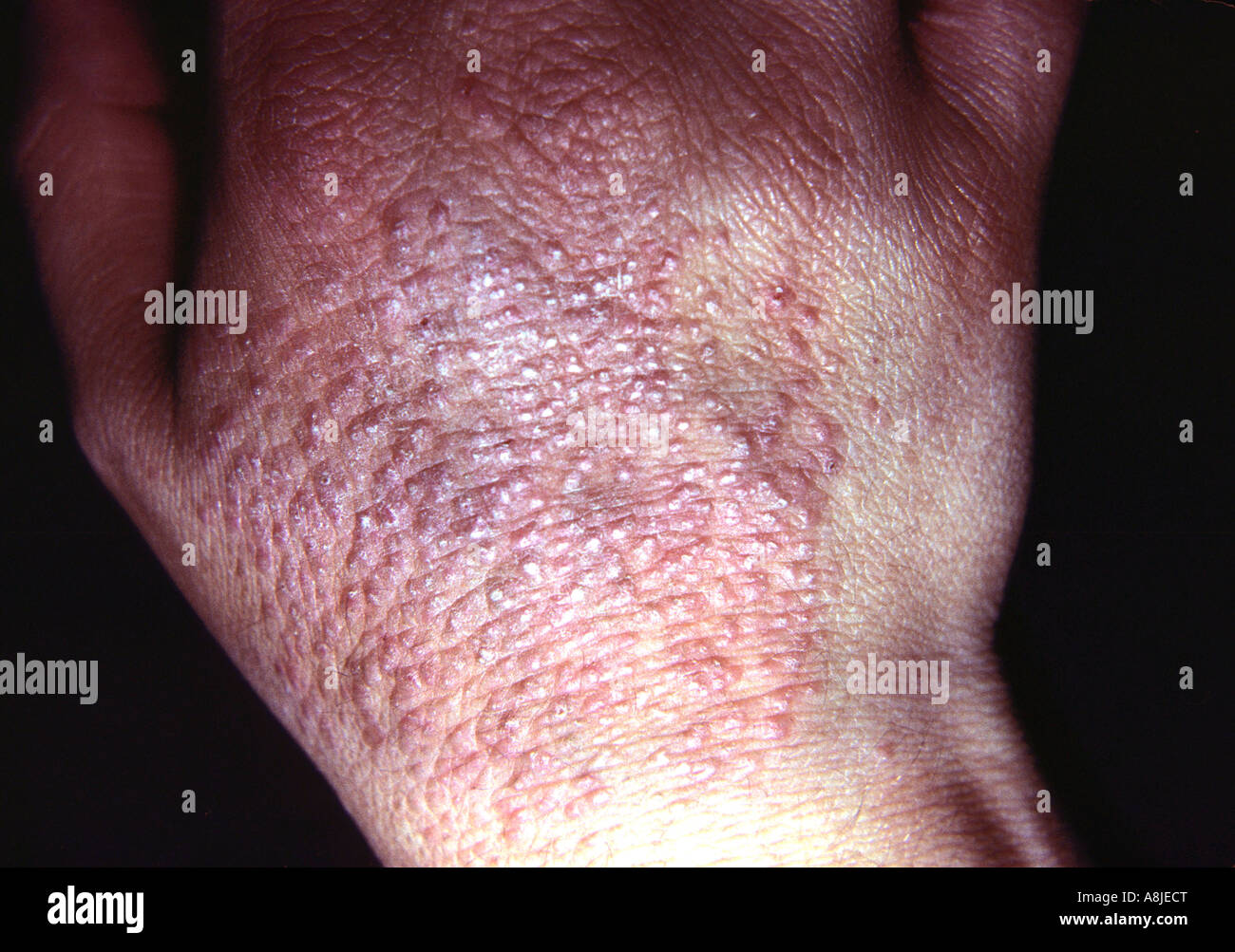 Skin rash eczema on hands Banque de photographies et d’images à haute ...