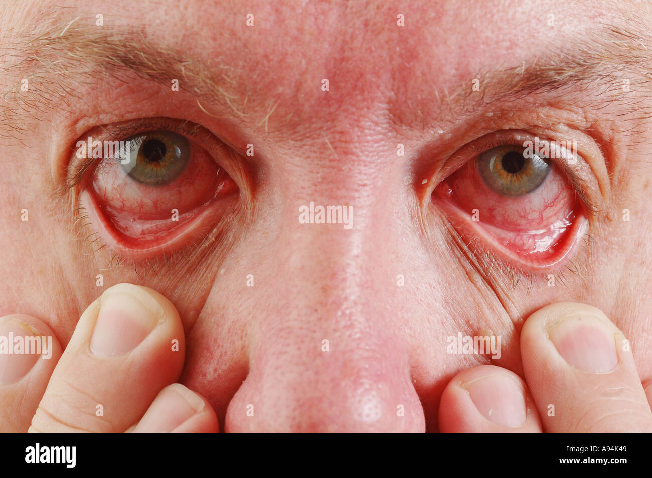 Mes yeux injectés de sang après avoir quitté pour lentilles de contact ...