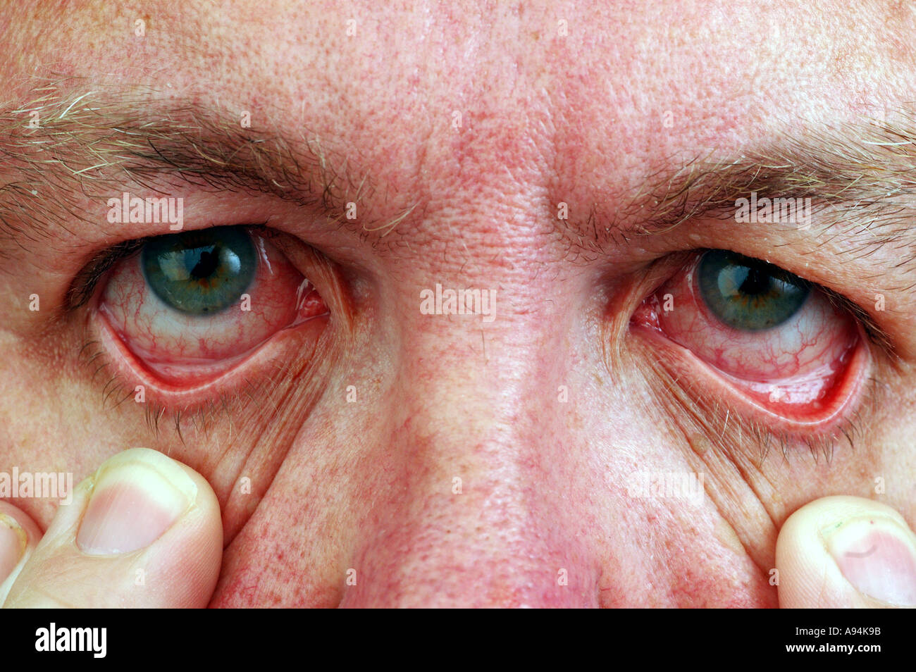 Œil injecté de sang yeux Banque de photographies et d’images à haute ...