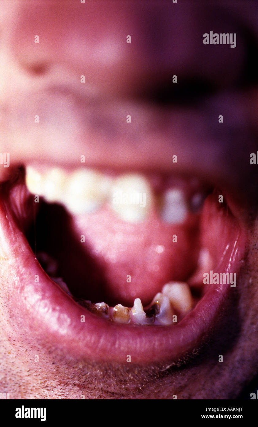 Decaying teeth Banque de photographies et d’images à haute résolution - Alamy