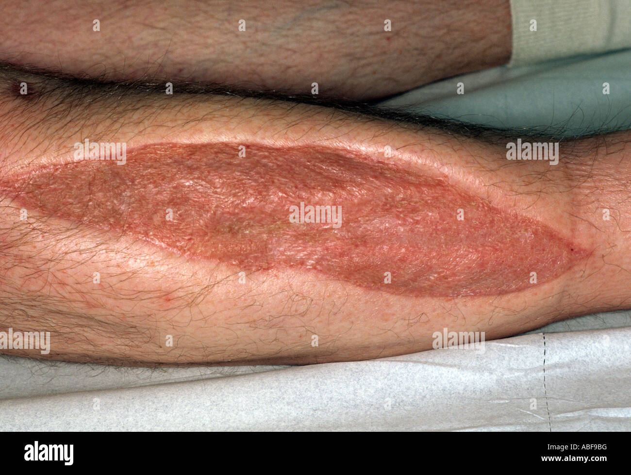 Compartment syndrome Banque de photographies et d’images à haute ...