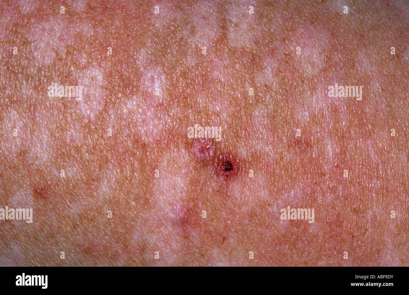 Prurigo nodulaire Banque de photographies et d’images à haute ...