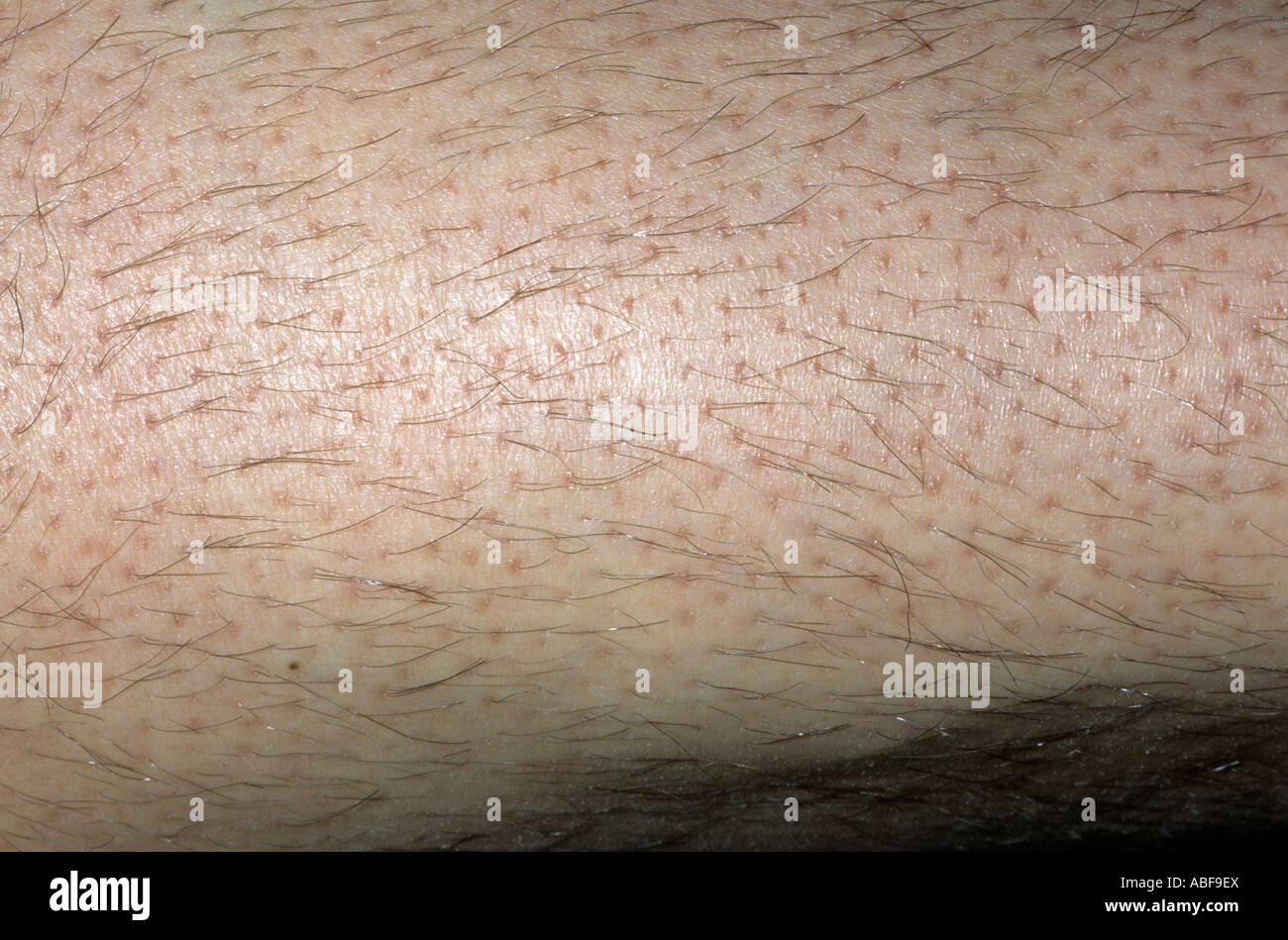 Hirsutisme Femme Banque d'image et photos - Alamy