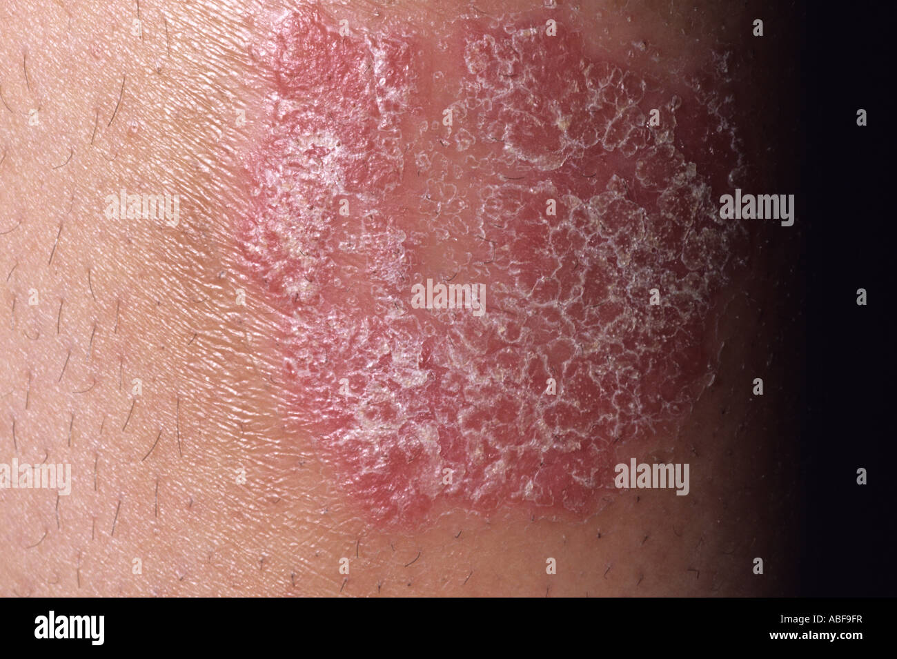 Psoriasis en plaques Banque de photographies et d’images à haute ...