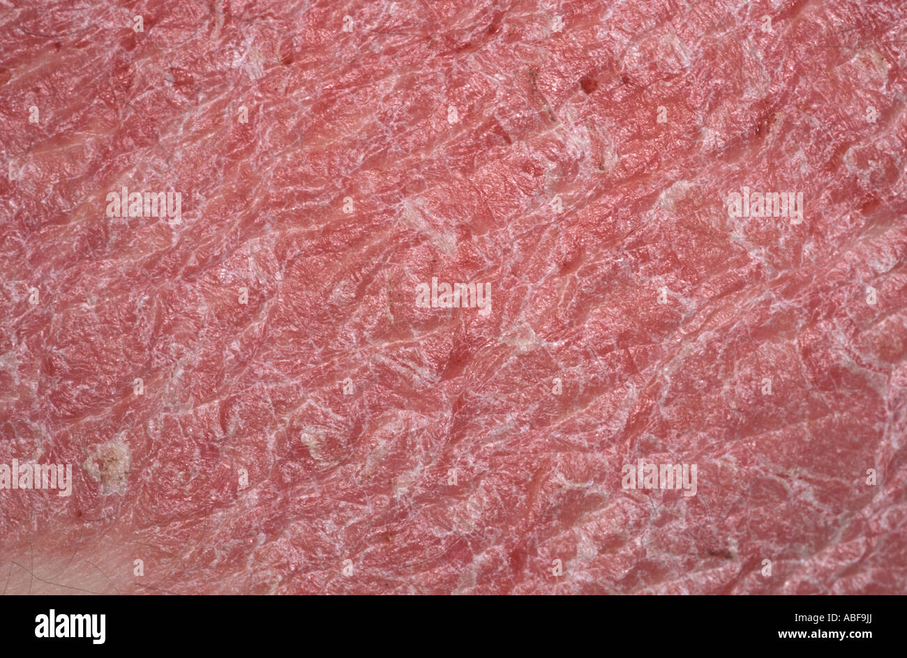 Psoriasis en plaques Banque de photographies et d’images à haute ...