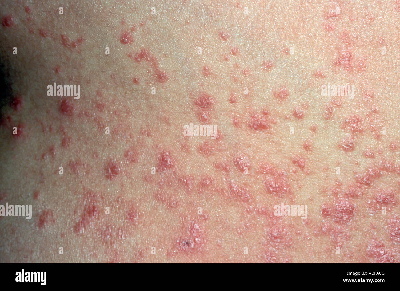 Psoriasis En Gouttes Banque d'image et photos - Alamy