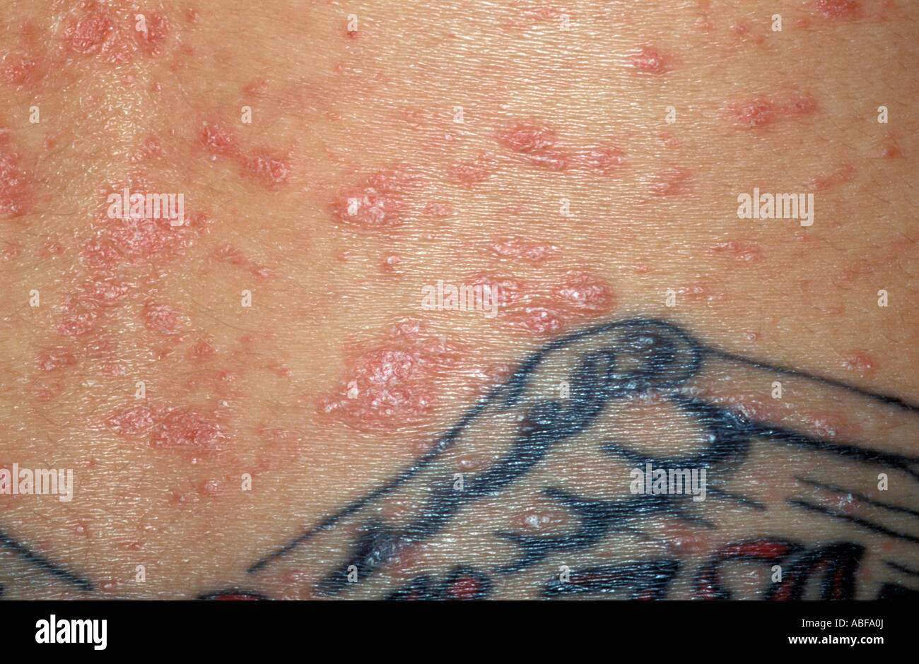 Psoriasis En Gouttes Sur Banque d'image et photos - Alamy