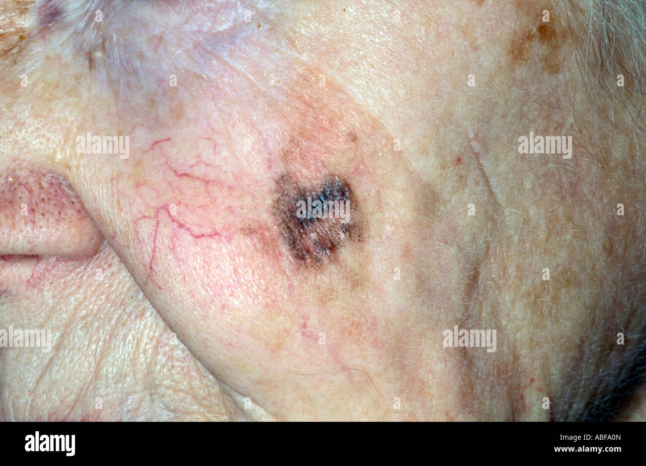 Mélanome à lentigo malin Banque de photographies et d’images à haute résolution - Alamy