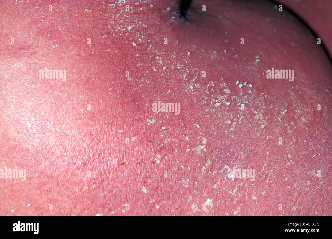 Psoriasis Érythrodermique Banque d'image et photos - Alamy