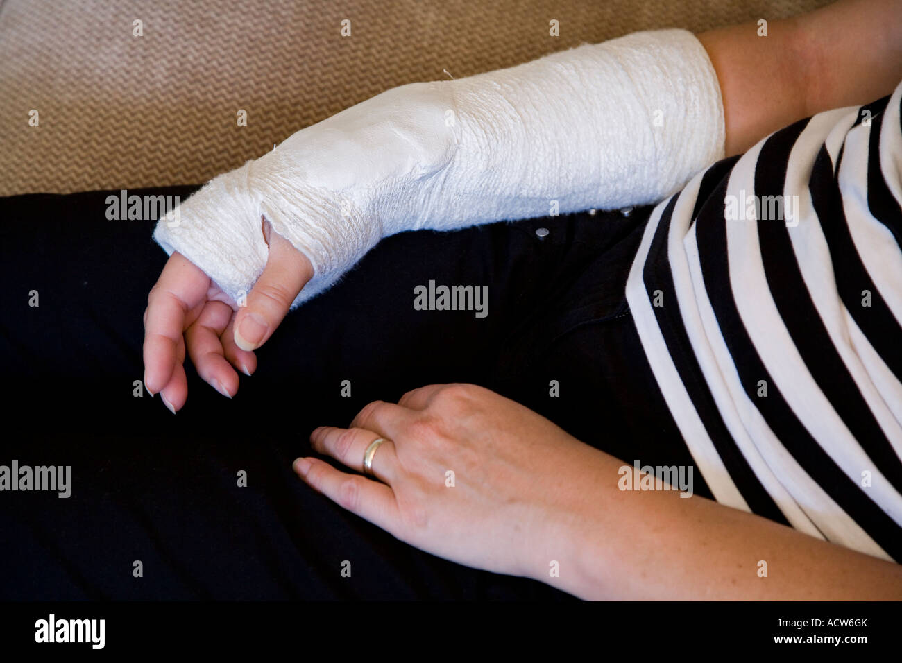 Un BRAS DROIT CASSÉ FRACTURE Pouteau-colles SITUÉ DANS LE PLÂTRE DE LA ...