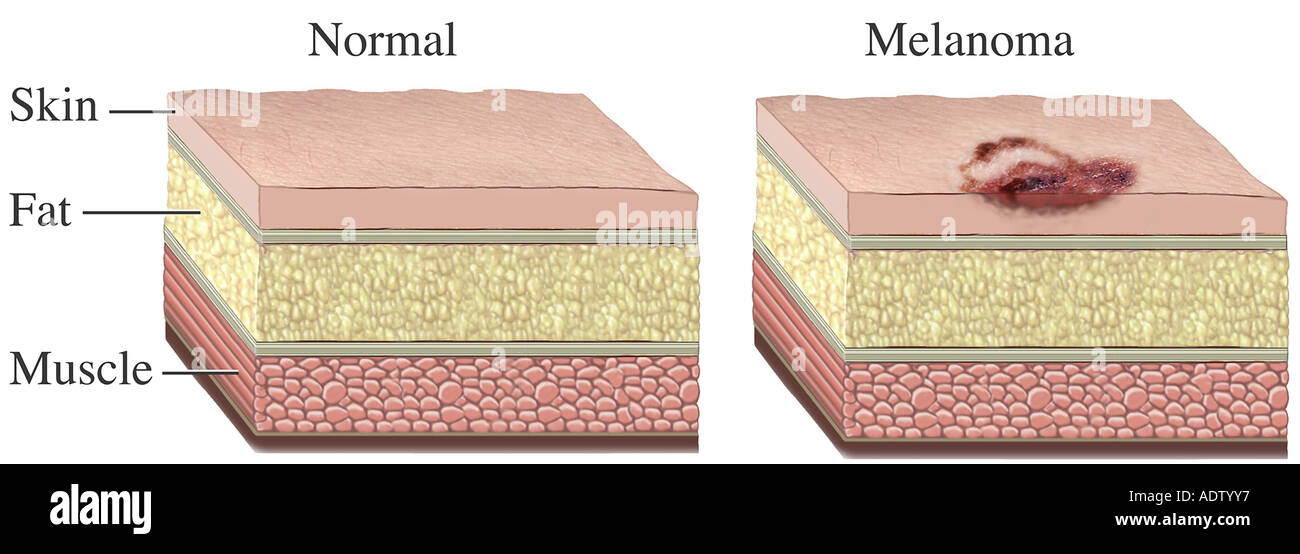 Le mélanome malin cancer des cellules de la peau Photo Stock - Alamy