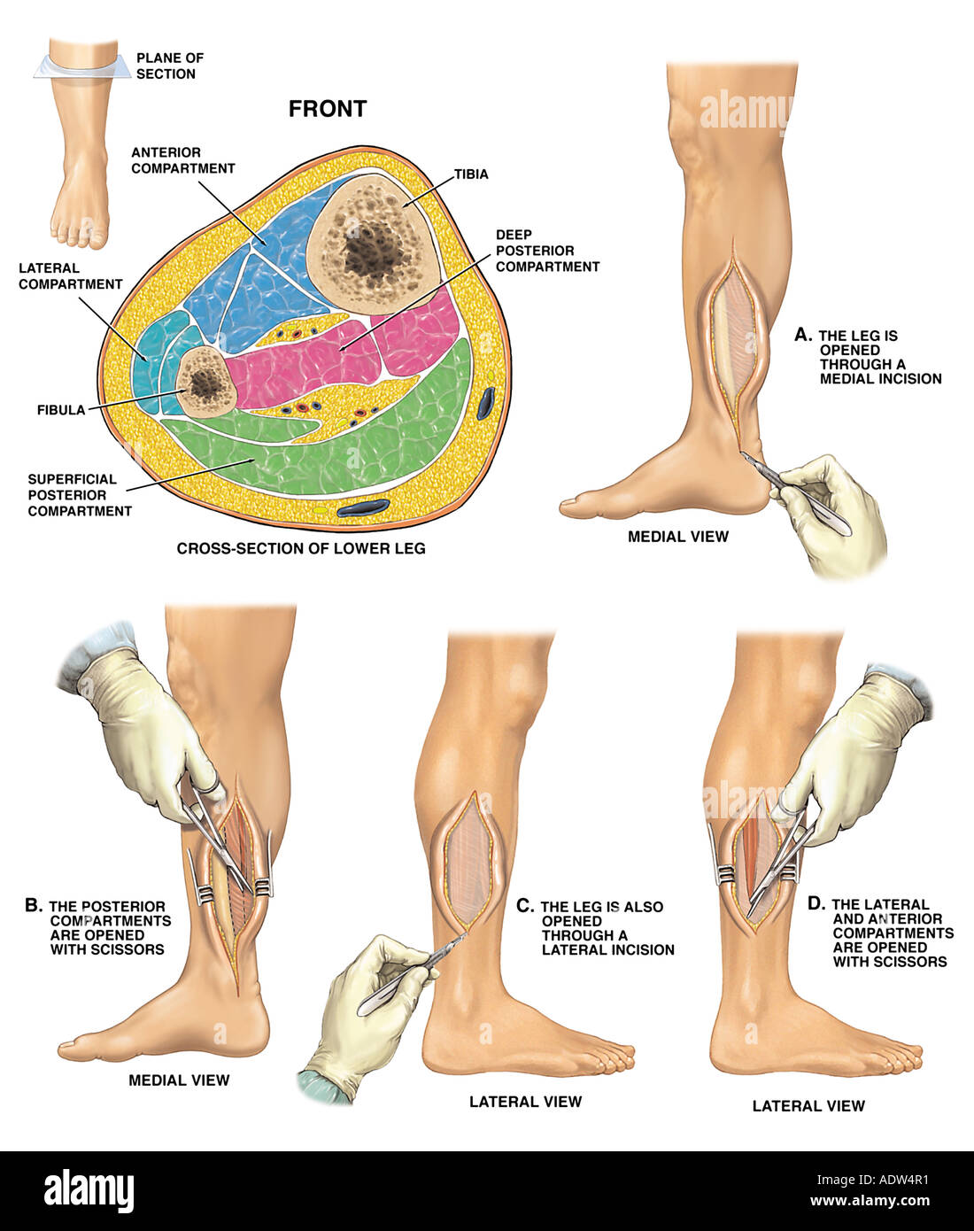 Compartment syndrome Banque de photographies et d’images à haute ...