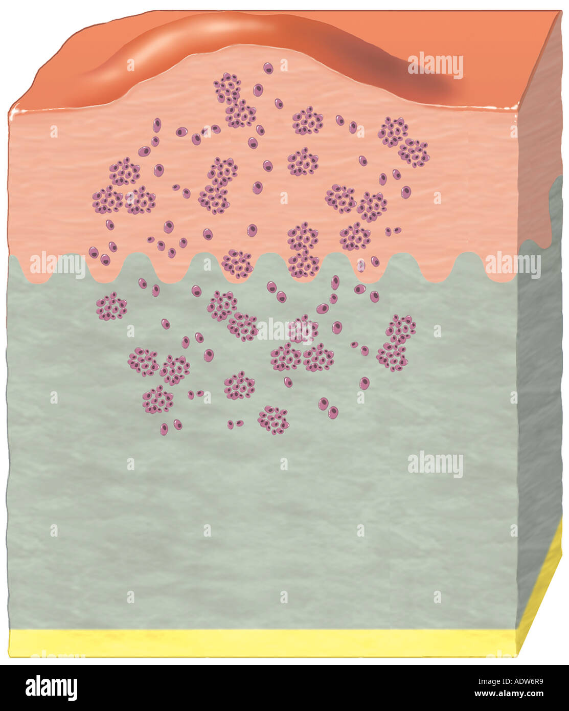Malignant melanoma skin cancer Banque de photographies et d’images à haute résolution - Alamy