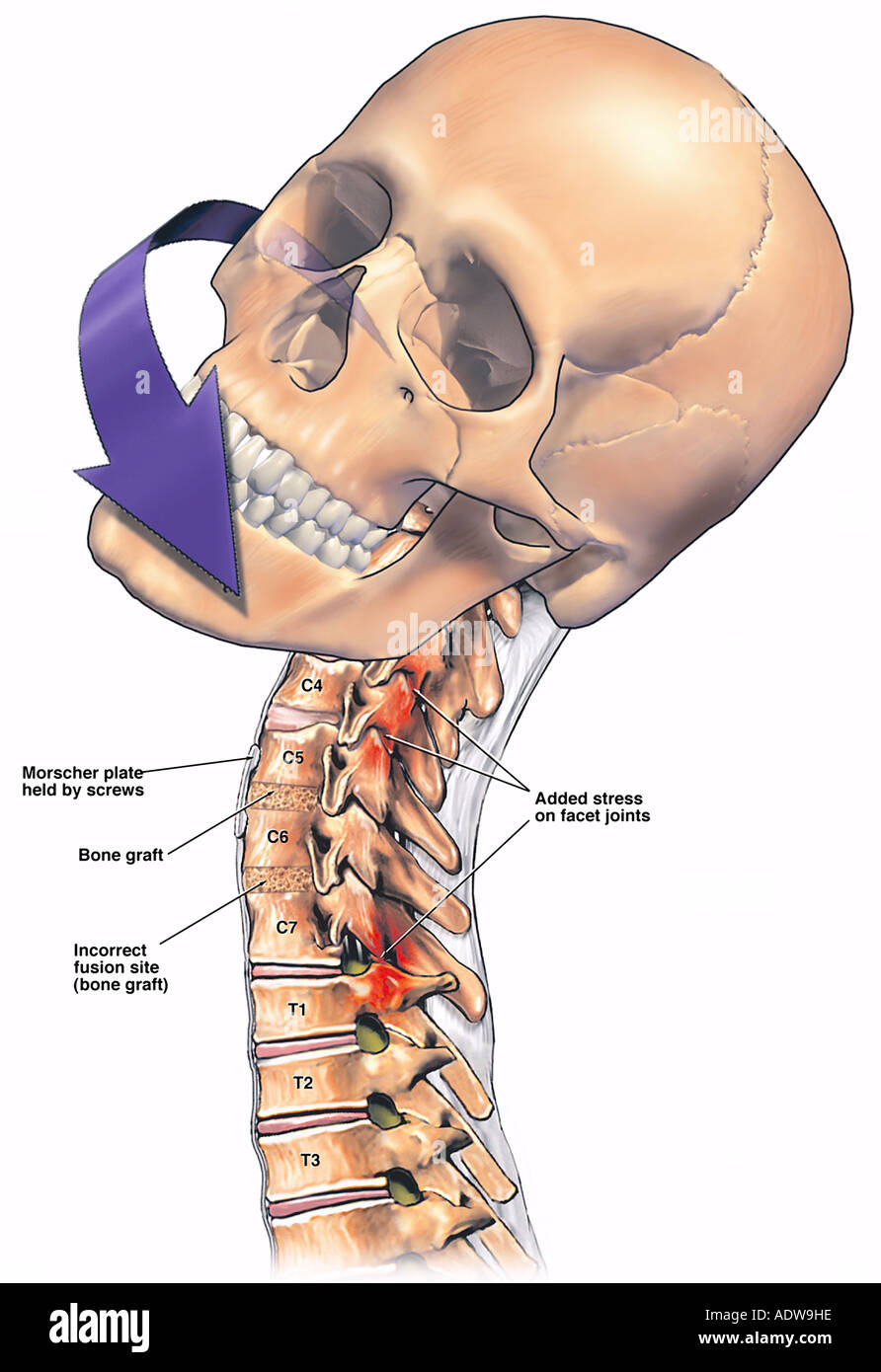 Cervical Bone Fusion Banque d'image et photos - Alamy