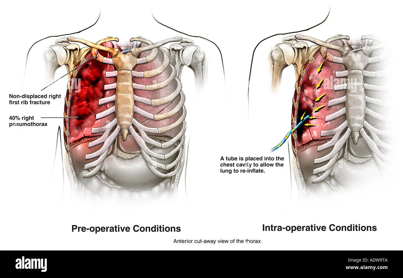 Fracture De La Côte Banque d'image et photos - Alamy