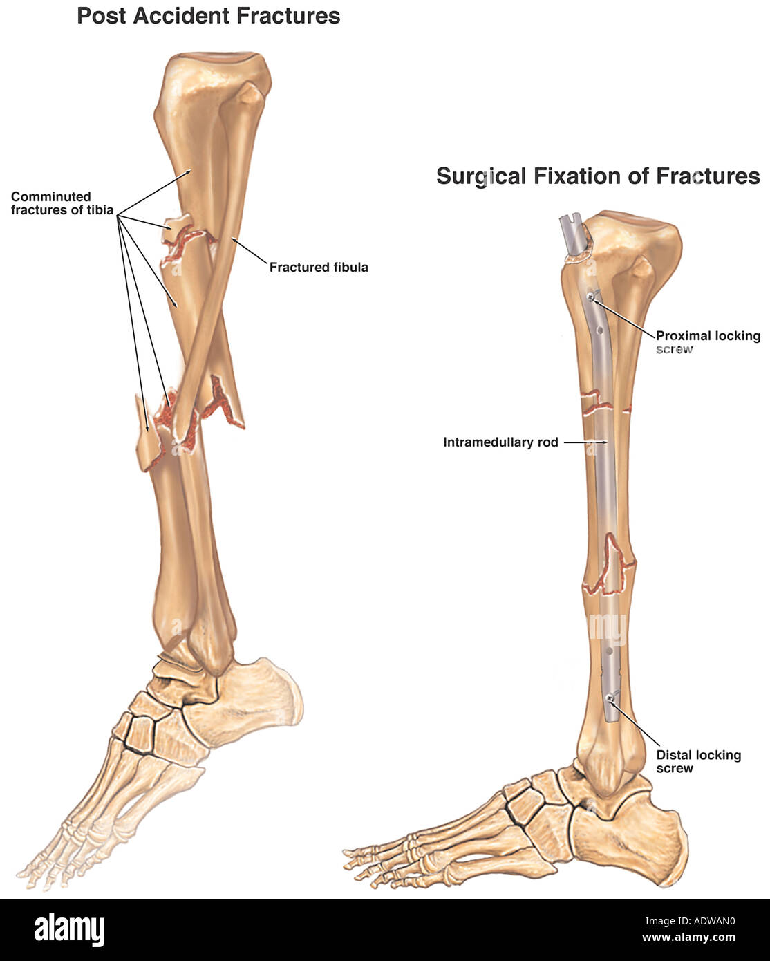 Fibular fracture Banque de photographies et d’images à haute résolution ...