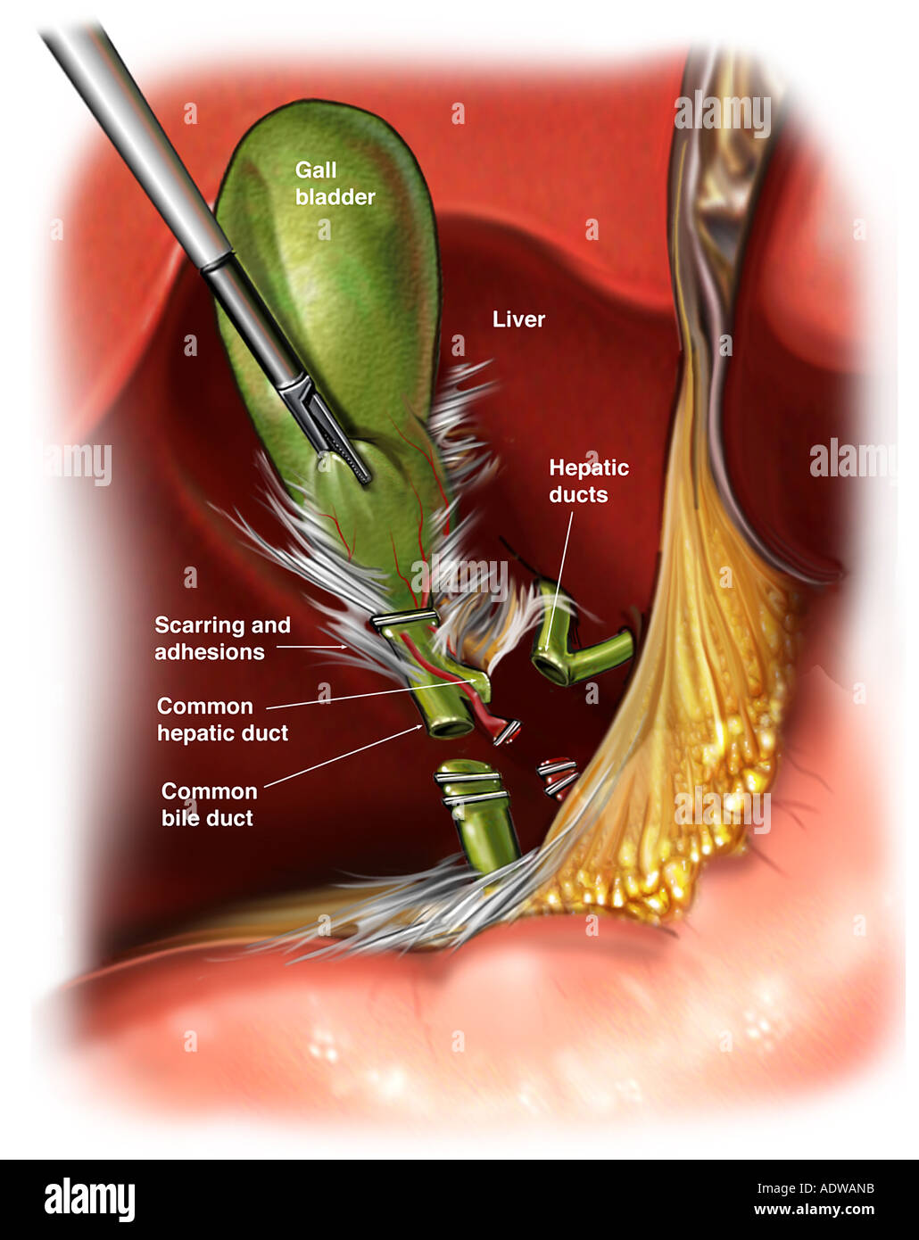 Canal Hépatique Commun Banque d'image et photos - Alamy