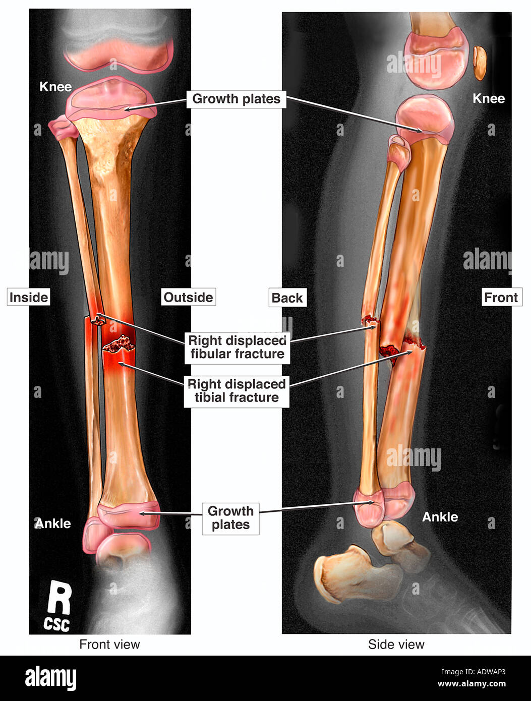 Taux Ipp Fracture Tibia Perone