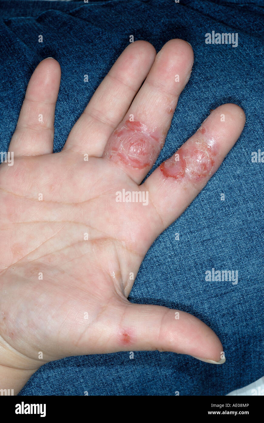 Dyshidrotic eczema Banque de photographies et d’images à haute ...
