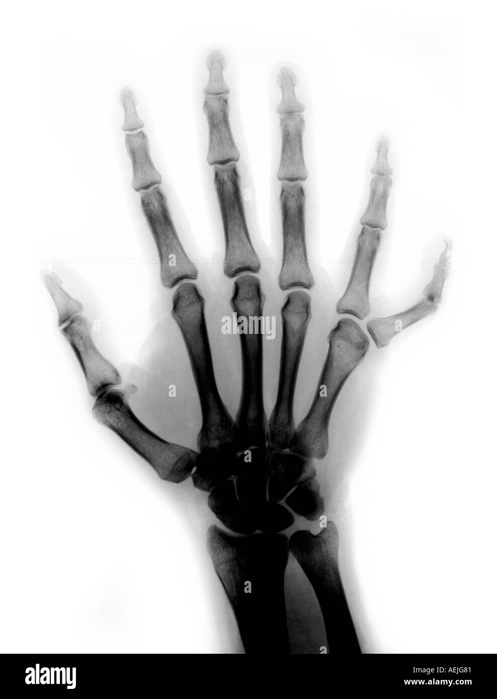 Radiographie de la main Banque d'images noir et blanc - Alamy