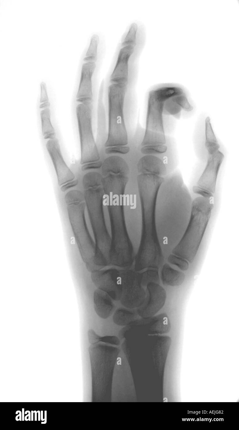 Radiographie de la main Banque d'images noir et blanc - Alamy