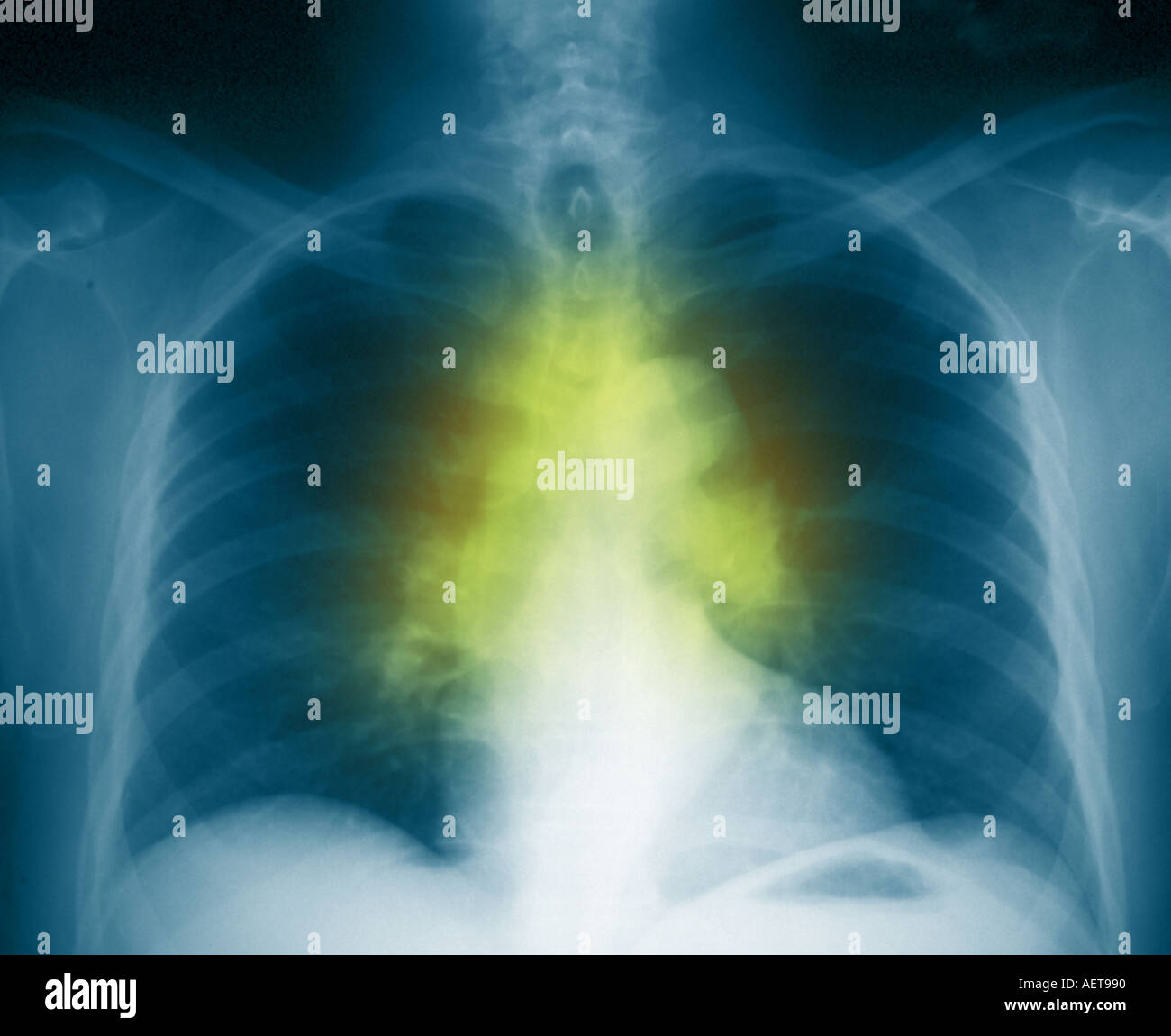 Rx thorax d'un patient qui a reçu un diagnostic de sarcoïdose Photo ...
