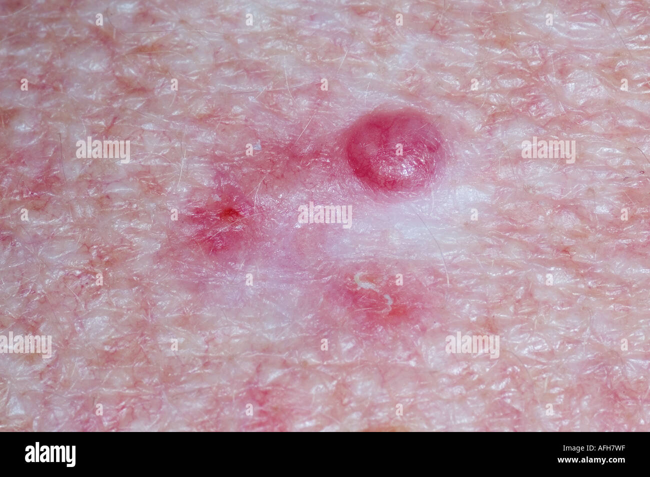 Nodular basal cell carcinoma Banque de photographies et d’images à haute résolution - Alamy