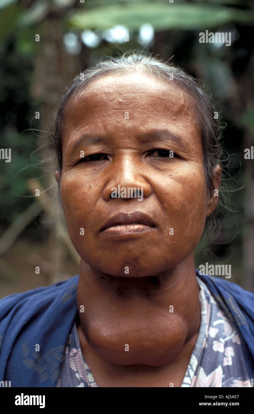 Goitre nodulaire Banque de photographies et d’images à haute résolution ...