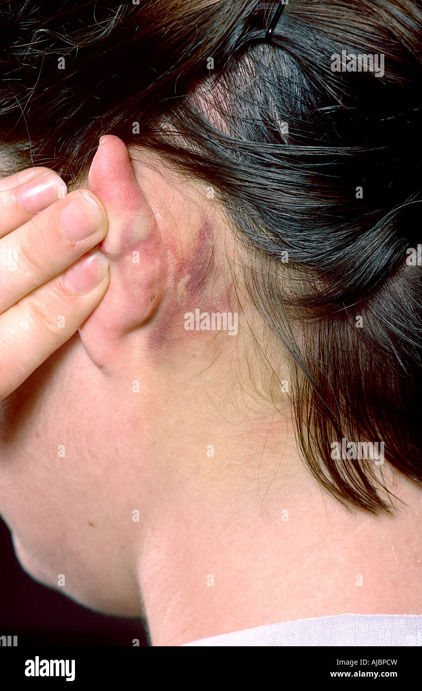 Photographie des batailles aussi signer une ecchymose mastoïdienne, une ...