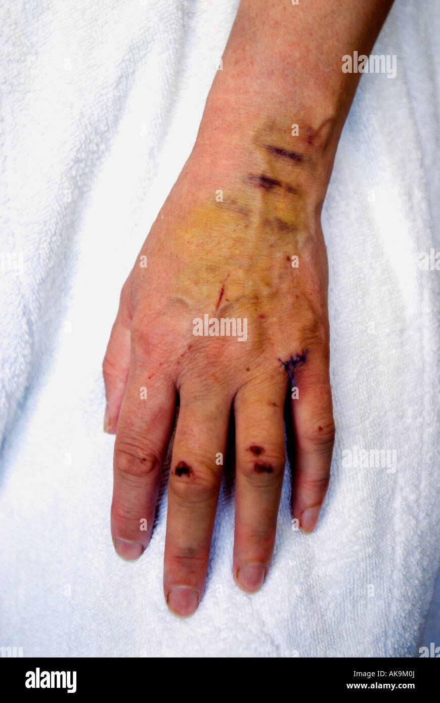 Dommage tissulaire Banque de photographies et d’images à haute ...