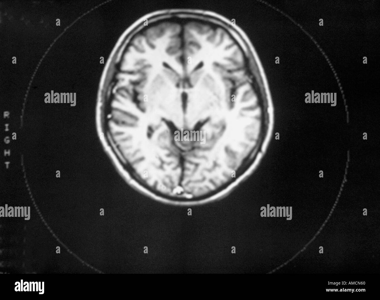 Analyse de l'anatomie normale - RMN Photo Stock - Alamy