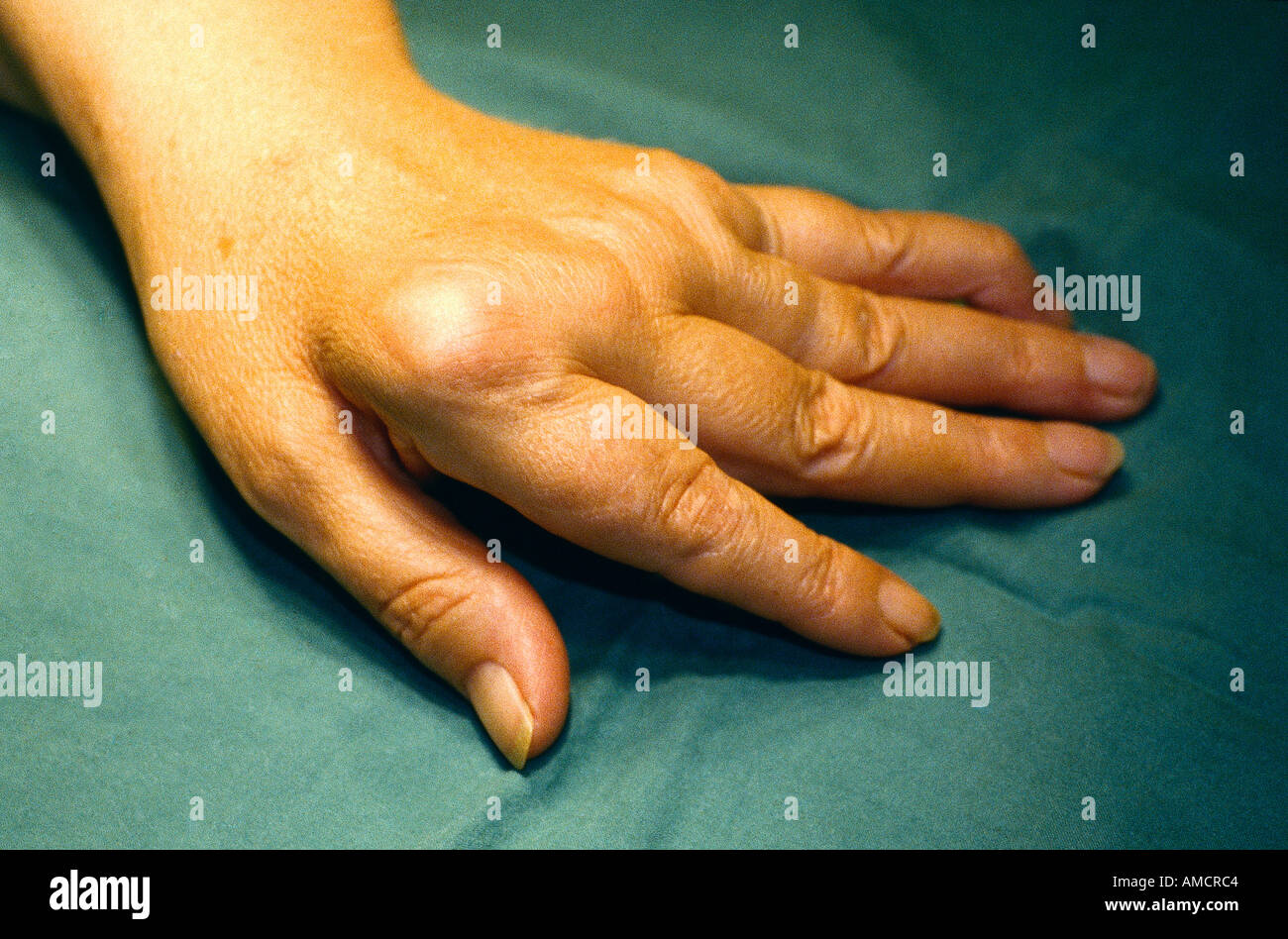 Une photographie de la main d'une victime d'arthrite rhumatoïde, avant ...