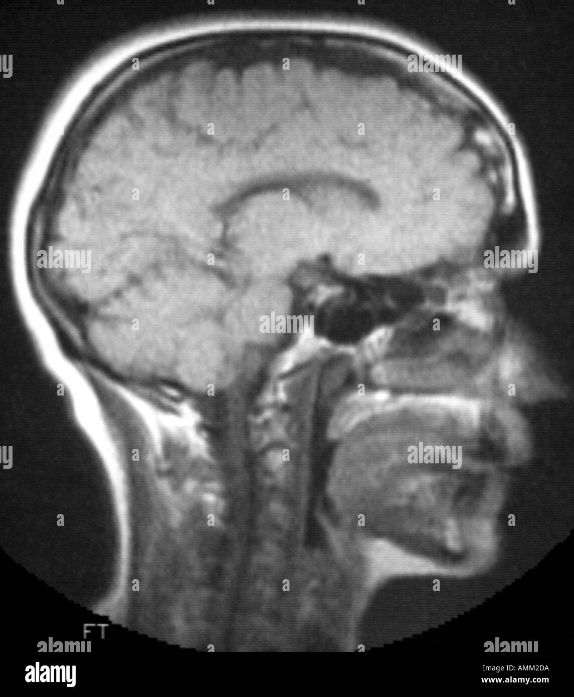 Irm normal du cerveau Banque de photographies et d’images à haute ...