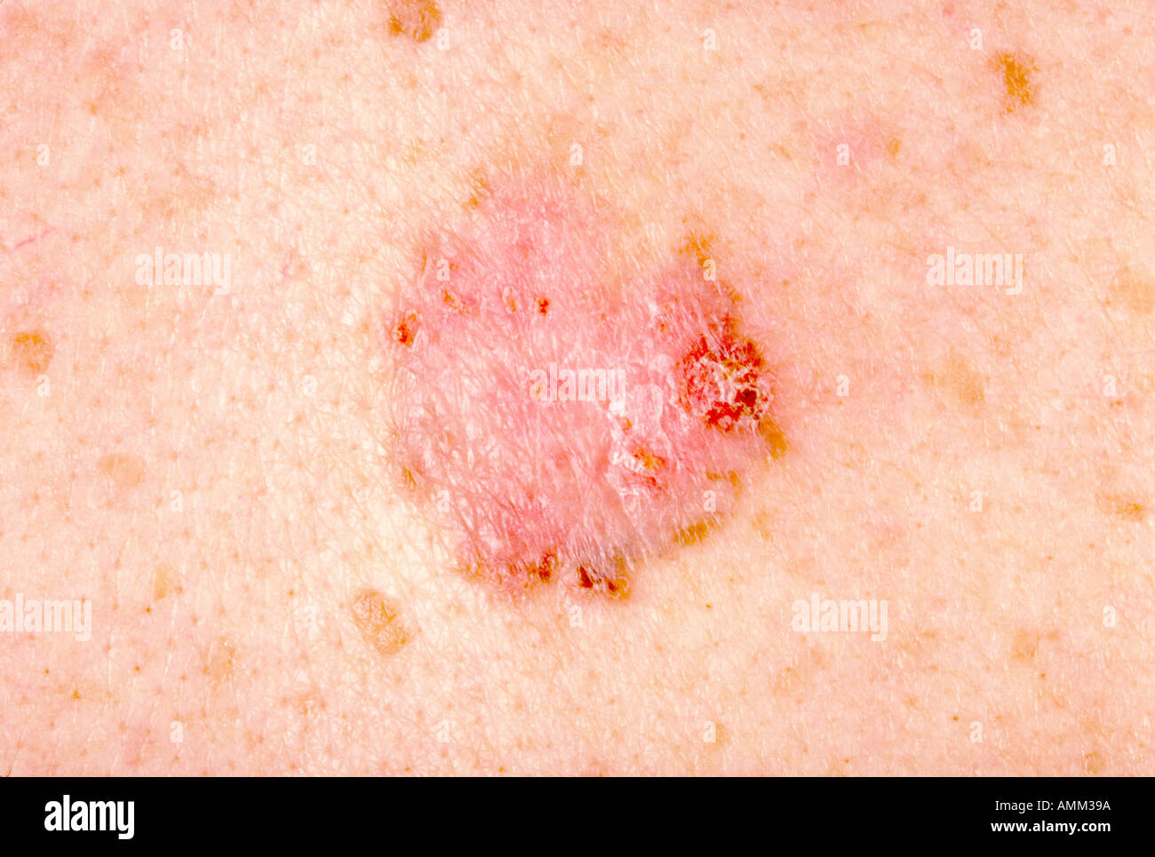 Le carcinome basocellulaire CCI Photo Stock - Alamy