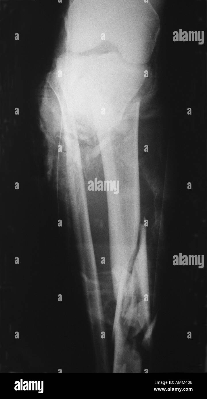 Fracture ouverte de la jambe Banque d'images noir et blanc - Alamy