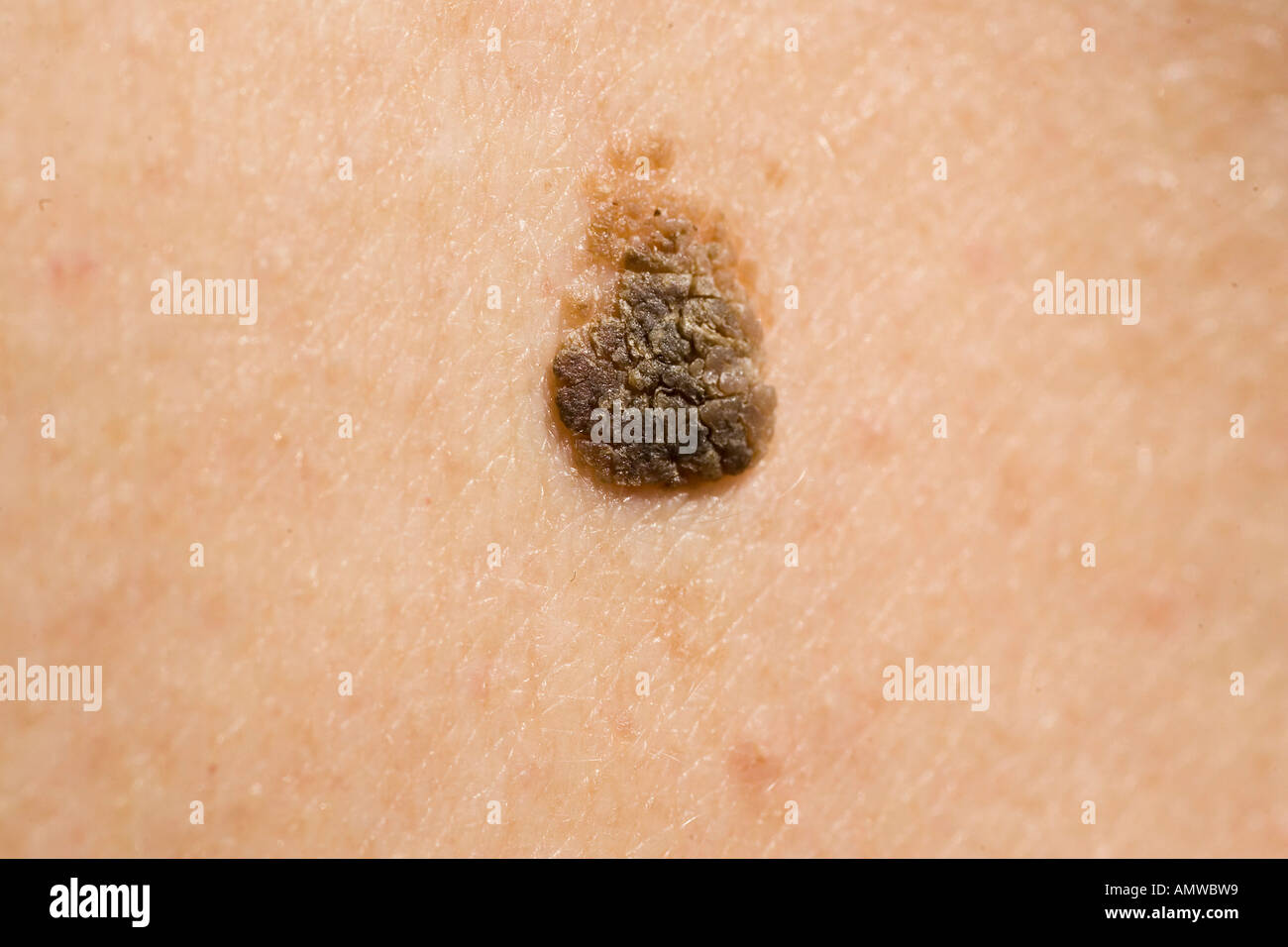 Verrue vulgaire Banque de photographies et d’images à haute résolution ...
