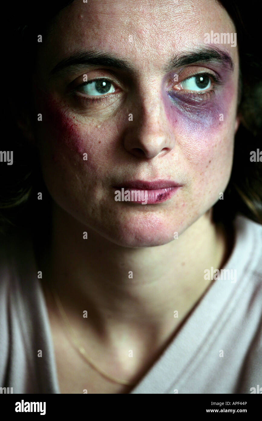Woman black eye abuse Banque de photographies et d’images à haute ...
