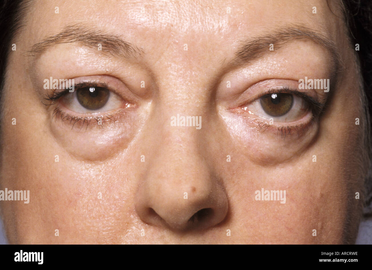 Thyroid eye disease Banque de photographies et d’images à haute ...