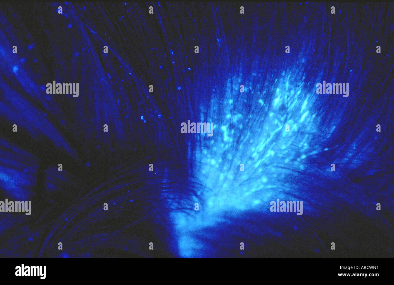 Tinea Capitis Banque d'image et photos - Alamy