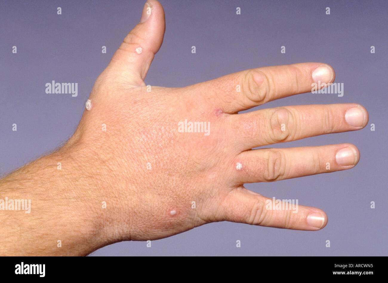 Une photographie de verrues communes (verruca vulgaris) sur les mains ...