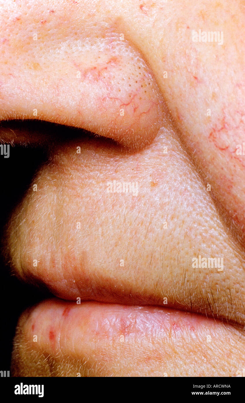 Une photographie de télangiectasie sur le visage, une condition de la ...