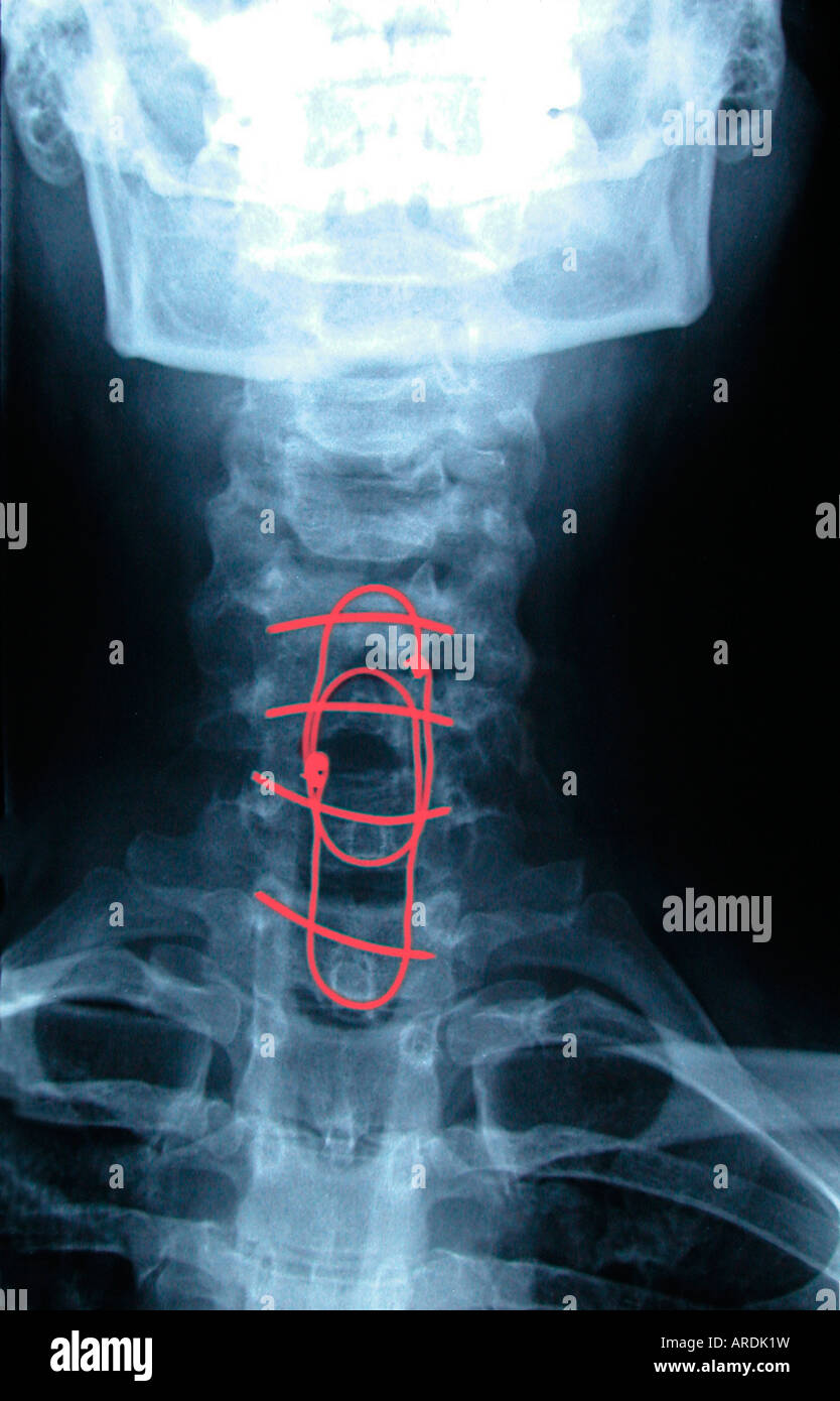 Rachis cervical radiographie d'une femme de 36 ans qui a subi une ...